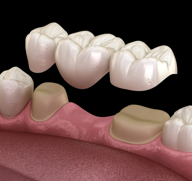 Crowns and Bridges | Panorama City, CA | Van Nuys Panorama Dental Center